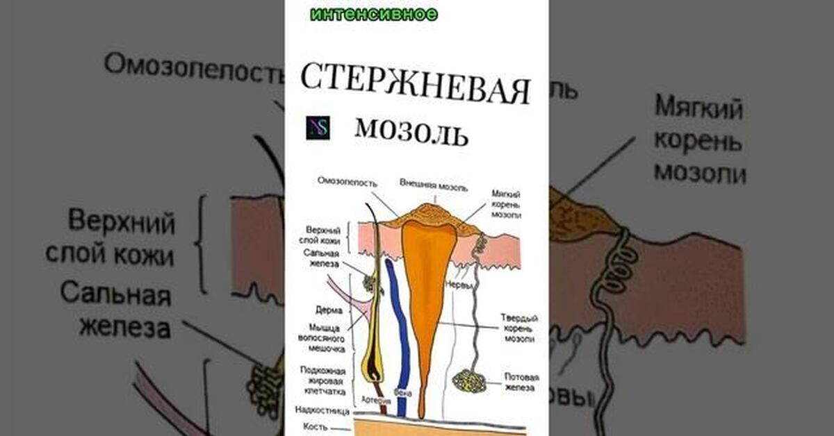 Стержневая мозоль. Причины | Пикабу